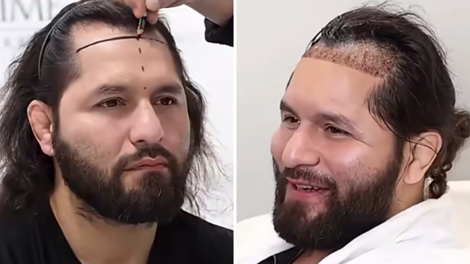 Jorge Masvidal undergoes hair transplant surgery - MMA Weekly