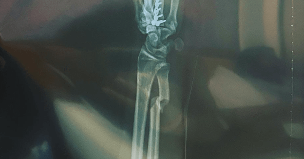 Alex Caceres shares X-ray of broken arm from UFC Singapore - MMAWeekly ...