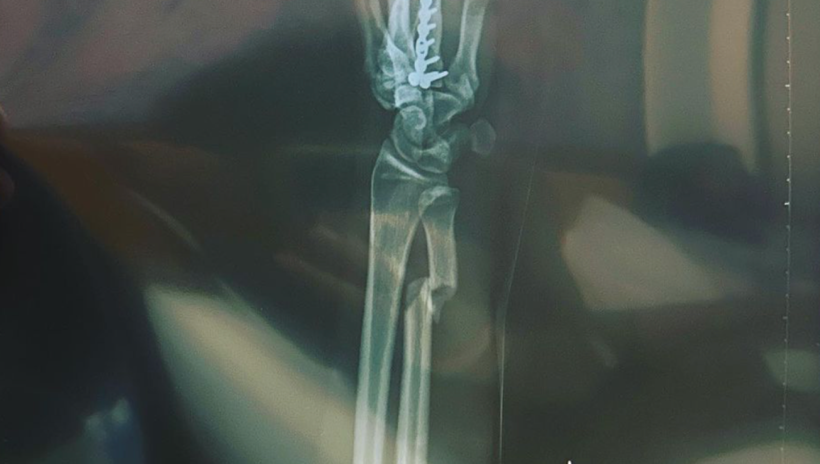 Alex Caceres shares X-ray of broken arm from UFC Singapore - MMAWeekly ...